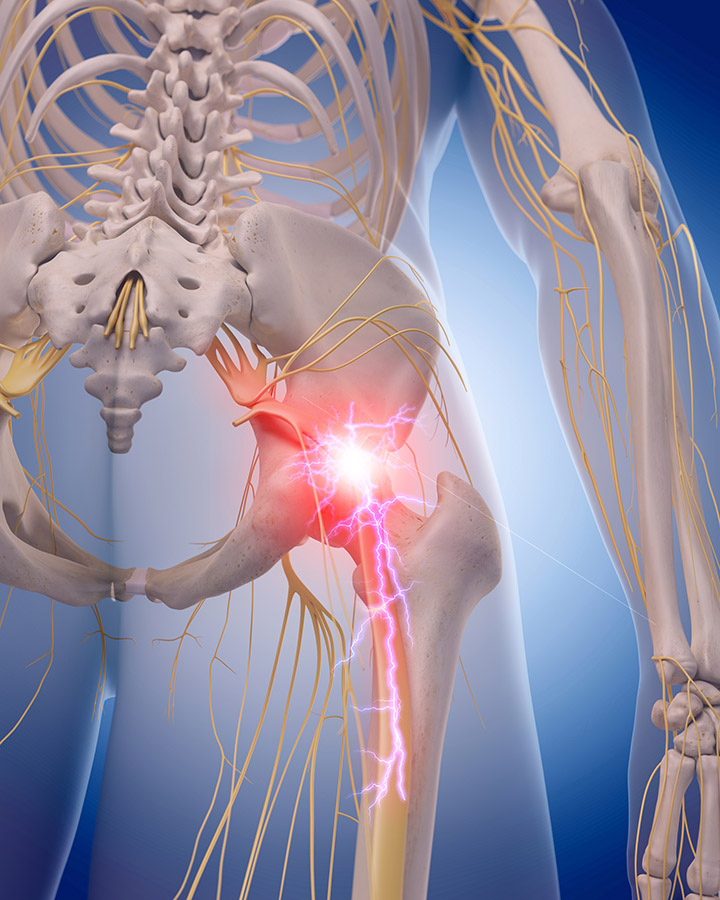 Treatment For Sciatica Sutton Osteopath Claire Craven
